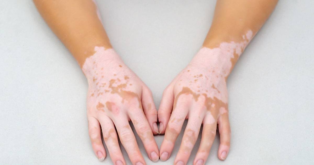 ¿Qué es el vitíligo y como curarlo? Aquí te mostramos