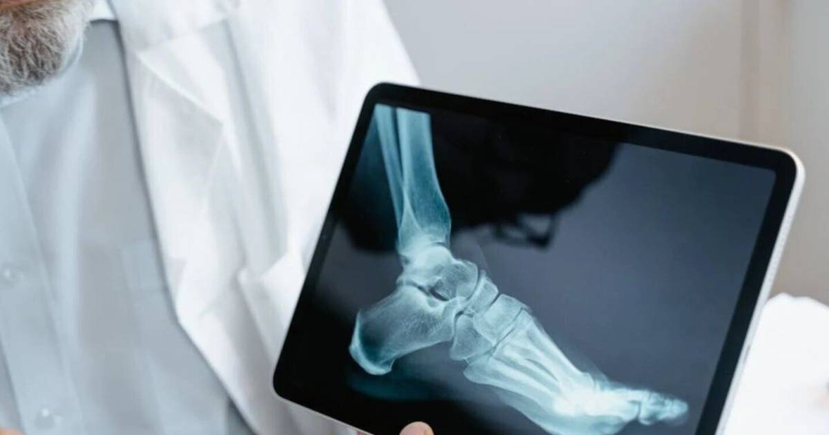 Consejos médicos para reducir el riesgo de fracturas en tibia y pie ...