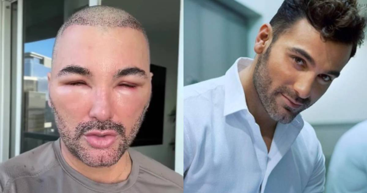 ¿Qué pasó con el rostro del actor Mauricio Mejía?